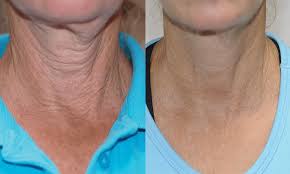 Exilis Ultra Neck Package of 6 – Elite Aesthetic Clinic