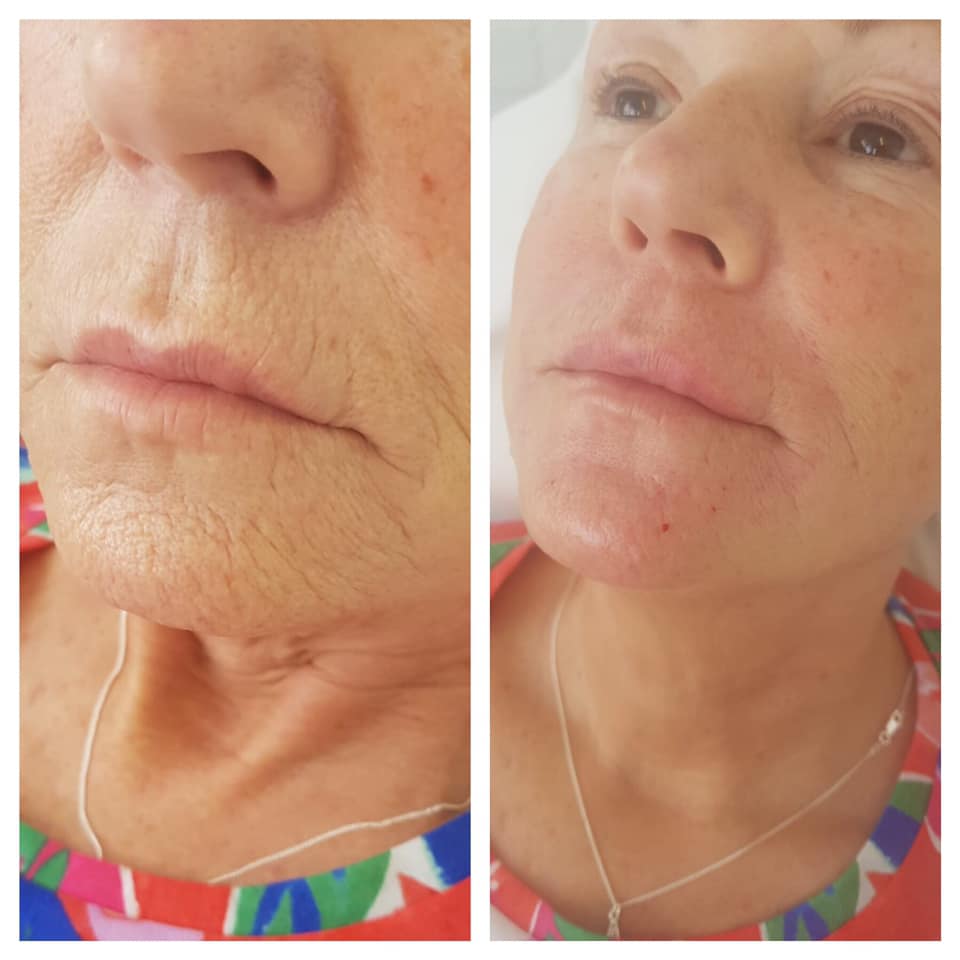 sunekos under eye protocol